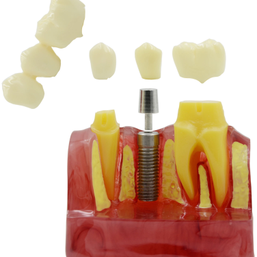 Model for Implant Analysis with Removable Crowns - Dent Zar, Inc